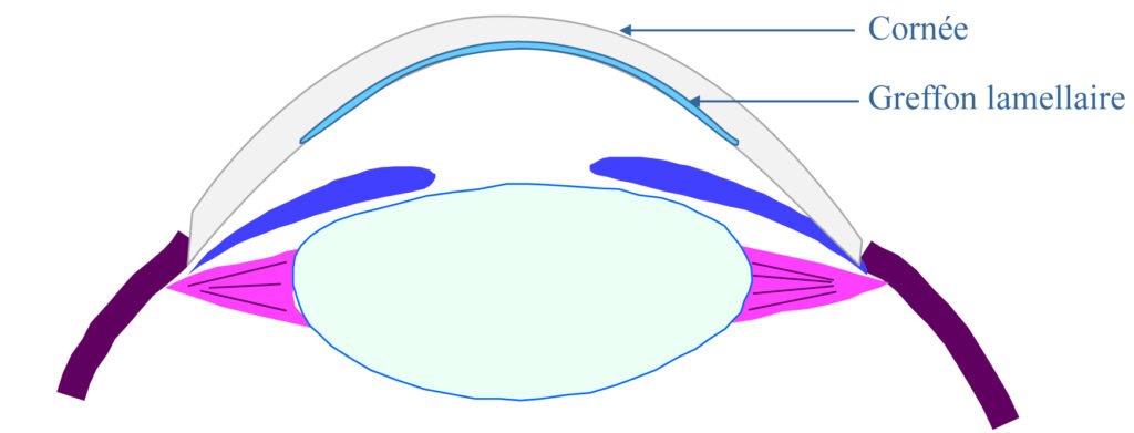 Greffe de cornée – Docteur Thierry Burtin